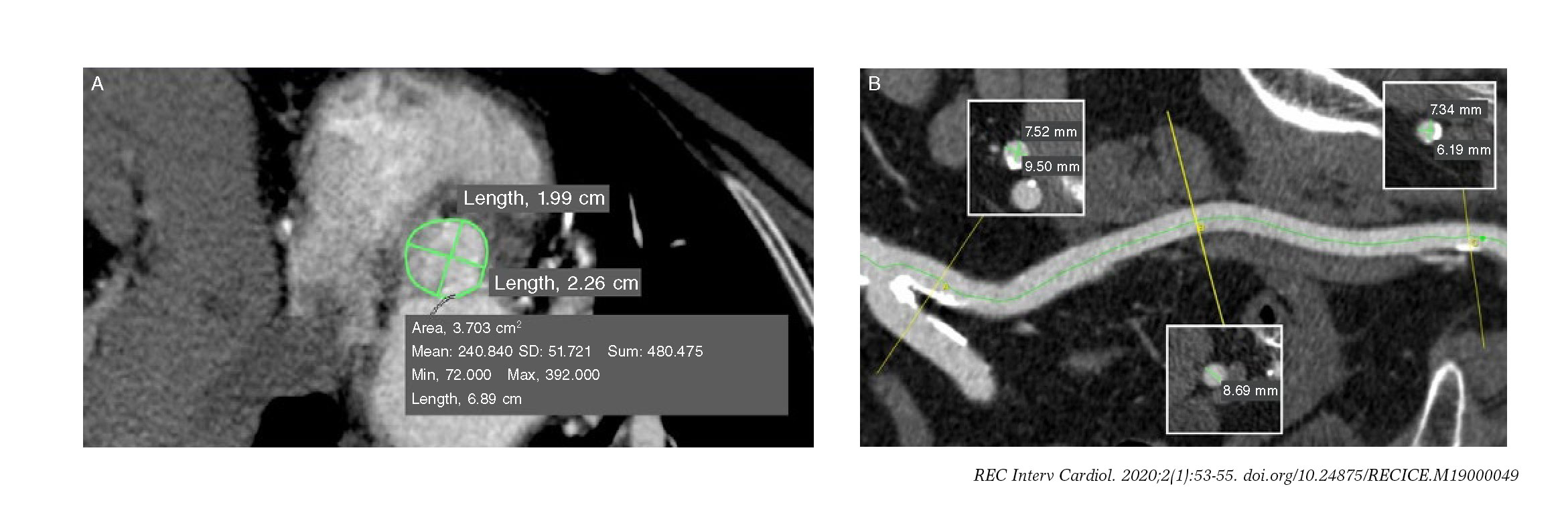 Simultaneous transfemoral TAVI and angioplasty of unprotected ...