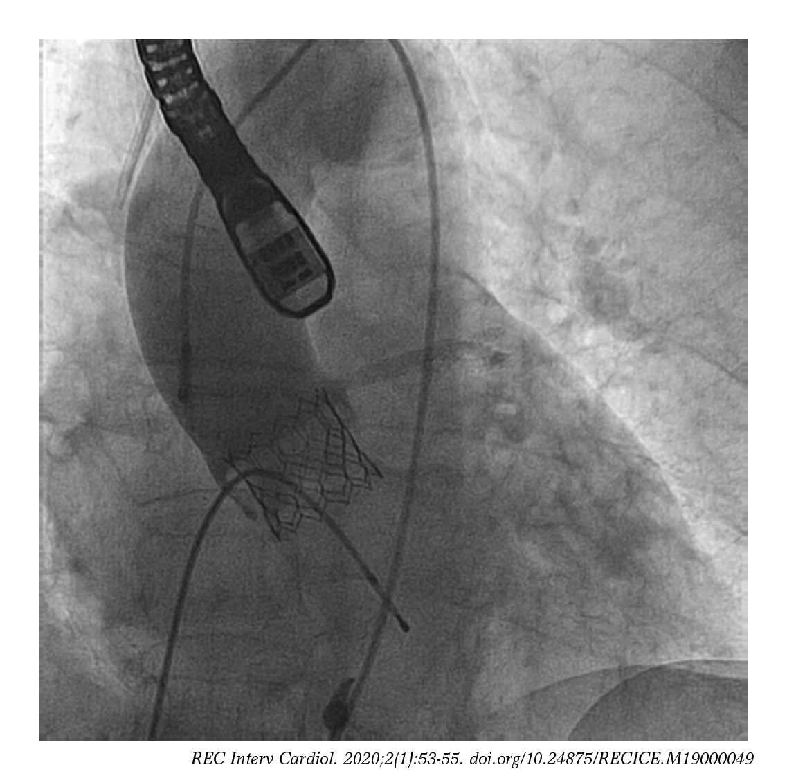 Simultaneous transfemoral TAVI and angioplasty of unprotected ...