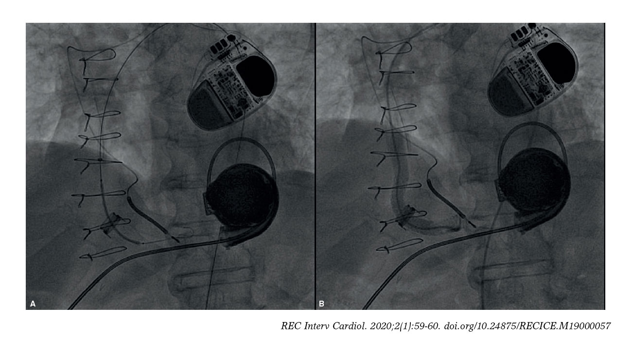 Stent implantation in a left ventricular assist device