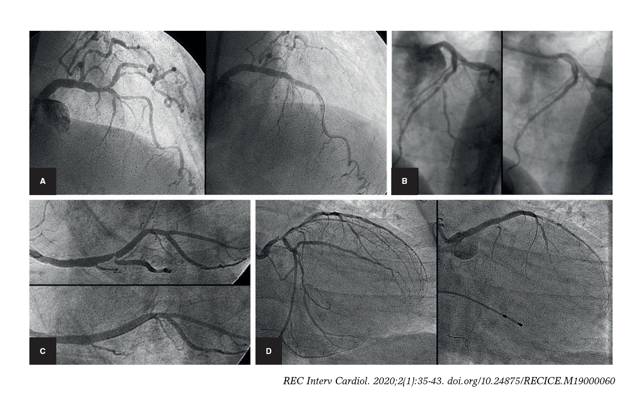 Percutaneous revascularization of coronary bifurcation lesions