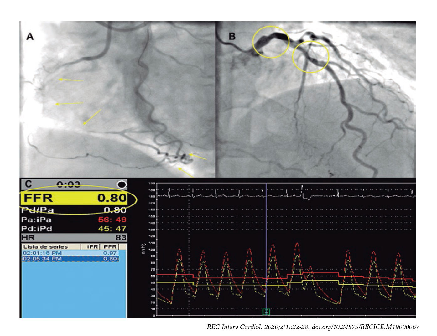 Functional assessment of intermediate lesions of collateral donor ...