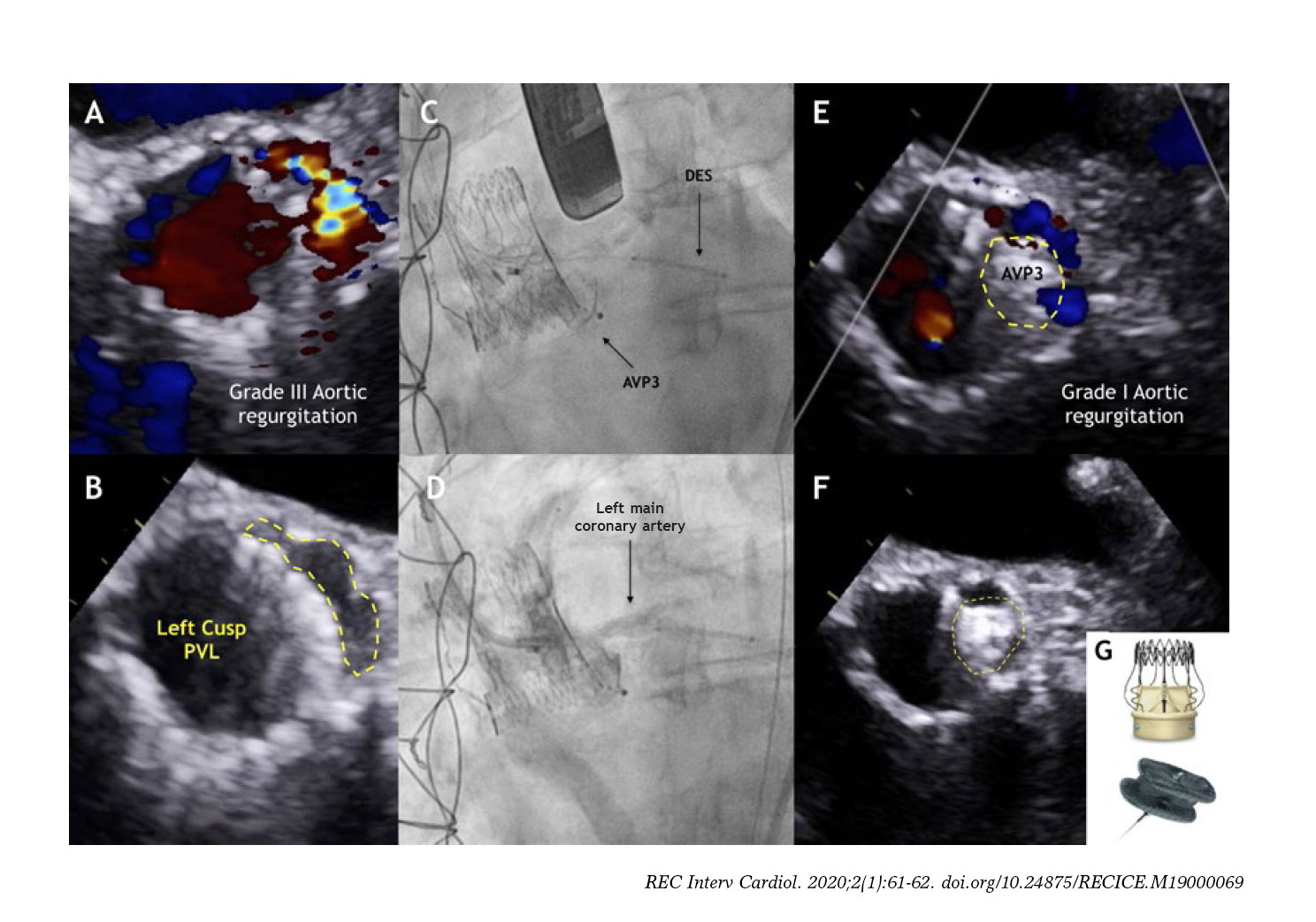 Paravalvular leak closure in a Perceval-after-Mitroflow procedure