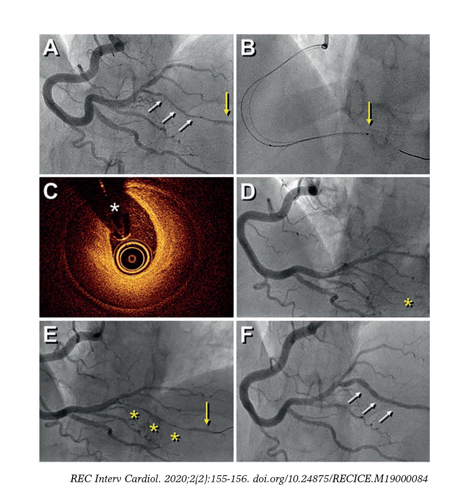 Spontaneous coronary dissection extension induced by optical coherence ...