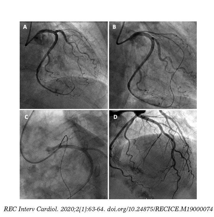 Retrograde approach with single radial vascular access
