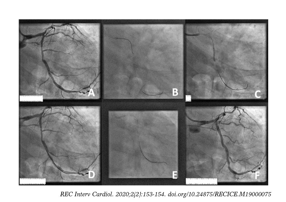 iFR variations during coronary angioplasty