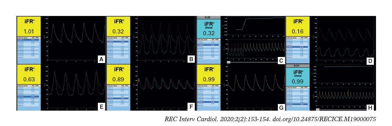 iFR variations during coronary angioplasty