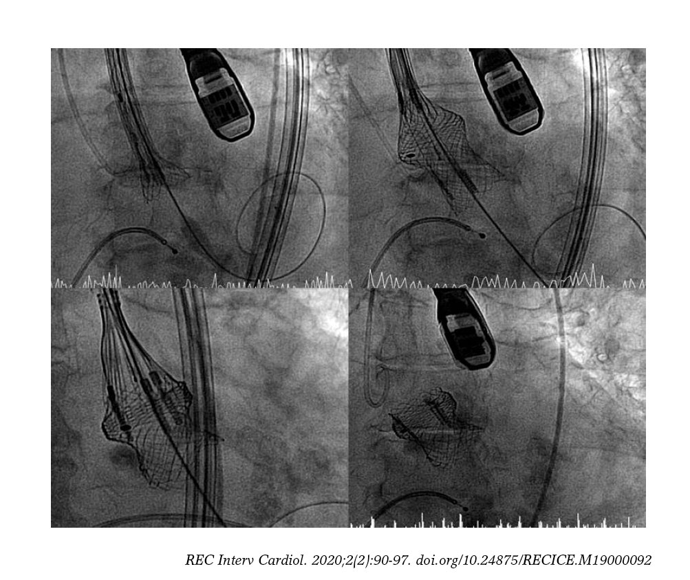 Multicenter experience with a second-generation fully-retrievable and ...