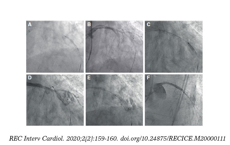 Coronary perforation after intracoronary lithotripsy in a chronic total ...