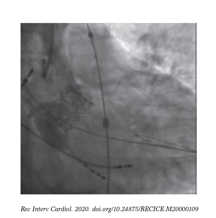 Specific indications for TAVI