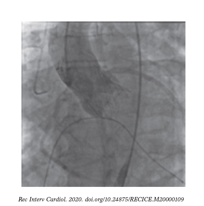 Specific indications for TAVI