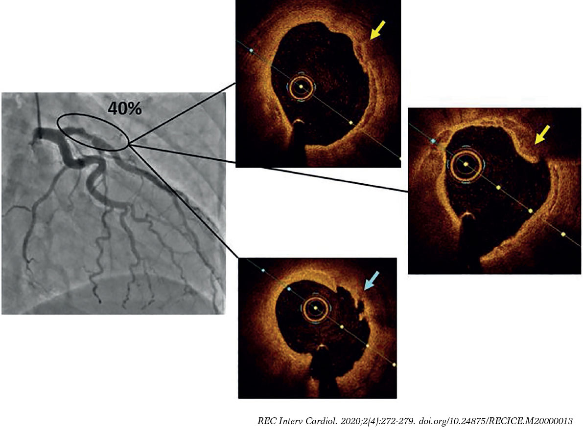 Value of the optical coherence tomography in the diagnosis of unstable ...