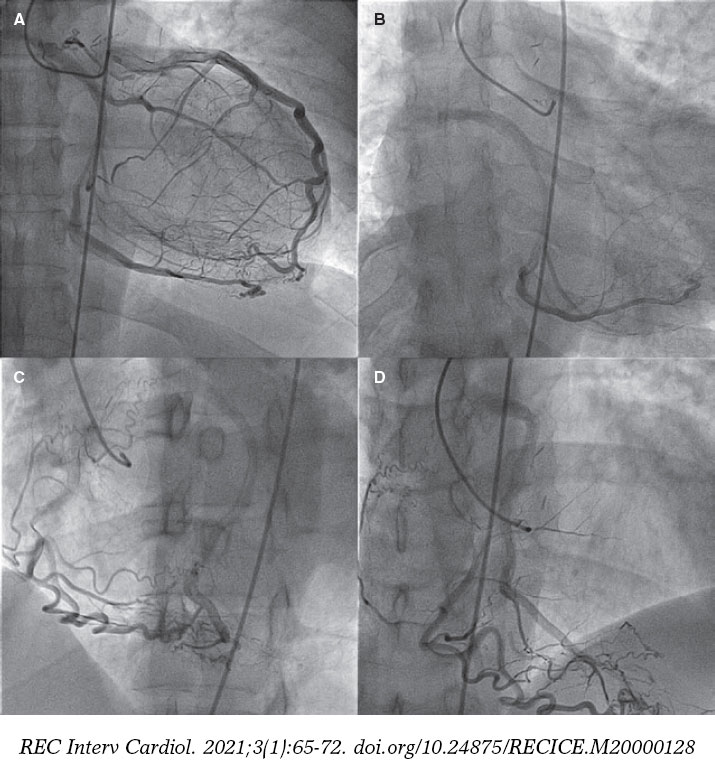 Anomalous origin of left circumflex artery from the right pulmonary ...