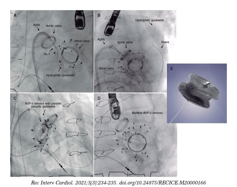 Percutaneous closure of multiple mitral paravalvular leaks