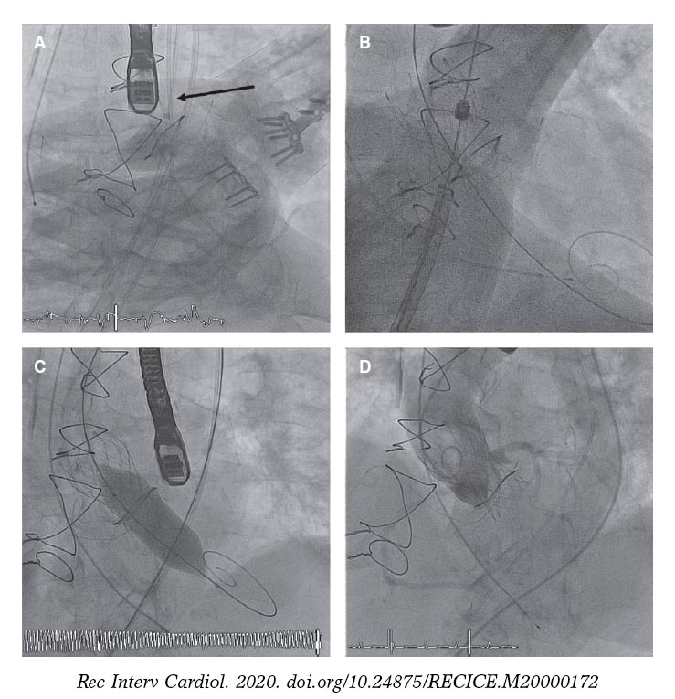 Prevention of coronary occlusions during transcatheter aortic valve-in ...
