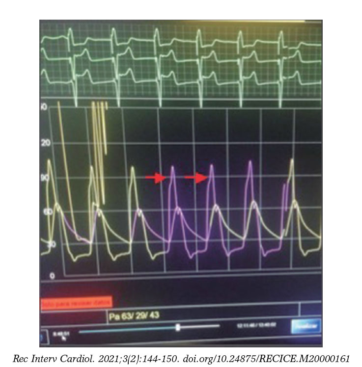 Shock after immediate TAVI implantation. Do we know what we are dealing ...