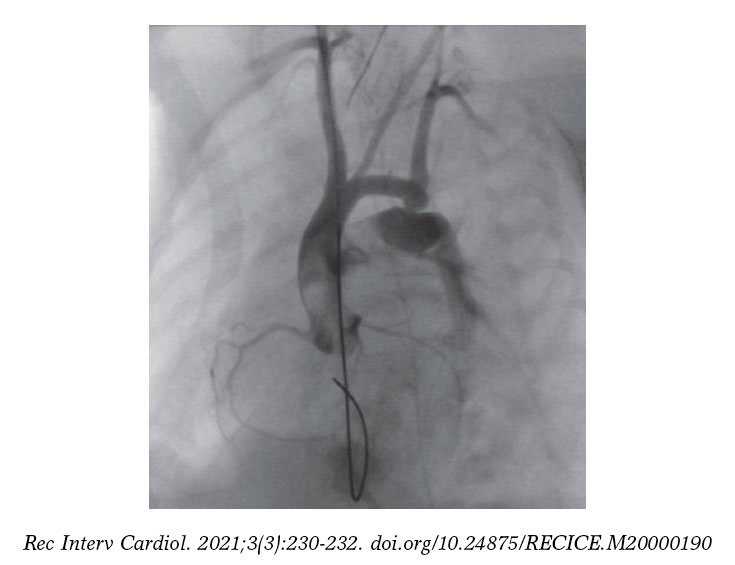 Critical aortic coarctation in very low weight premature: primary ...