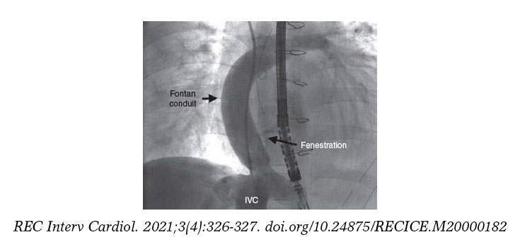 Mechanical thrombectomy with the AVP II device