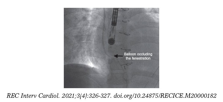 Mechanical thrombectomy with the AVP II device