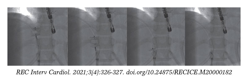 Mechanical thrombectomy with the AVP II device