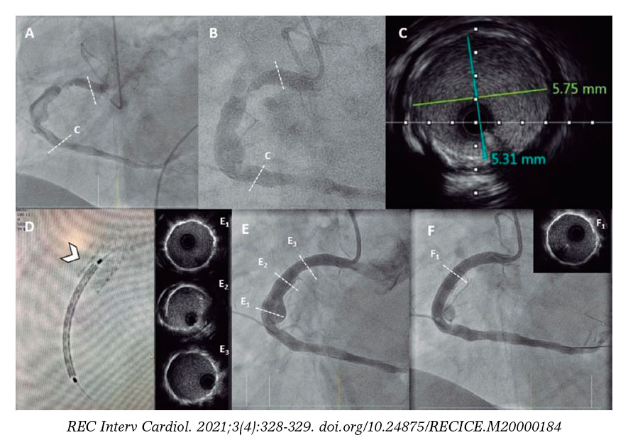 Incomplete giant aneurysm exclusion due to PK-Papyrus stent shortening