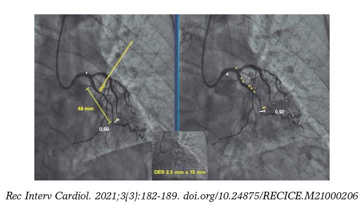 Usefulness of physiological coronary assessment with iFR in daily ...