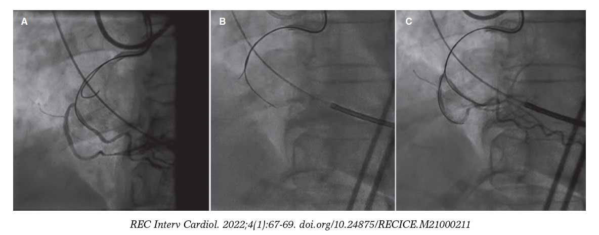 The ReCross dual-lumen microcatheter versatility during percutaneous ...