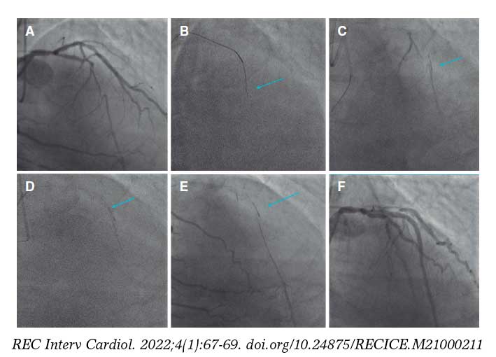 The ReCross dual-lumen microcatheter versatility during percutaneous ...