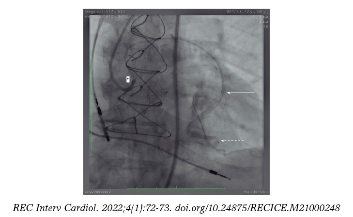 Telescoping catheter technique in percutaneous coronary intervention