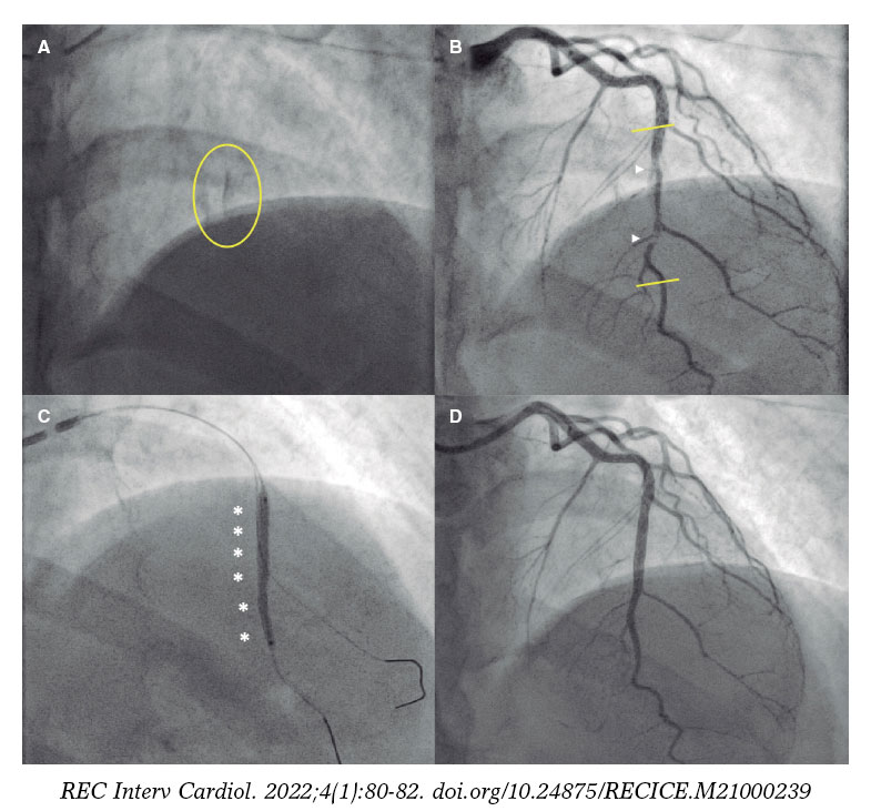 Acute failure of cutting balloon fenestration in spontaneous coronary ...