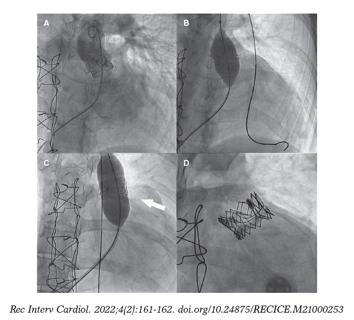 Pulmonary valve-in-valve procedure after fractured biological ...