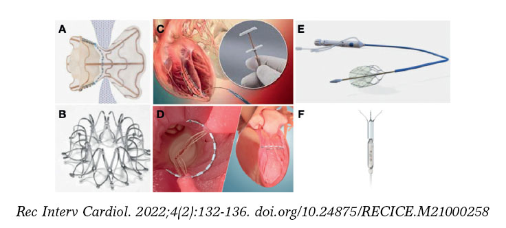 Interventional heart failure therapies: an emerging field in ...