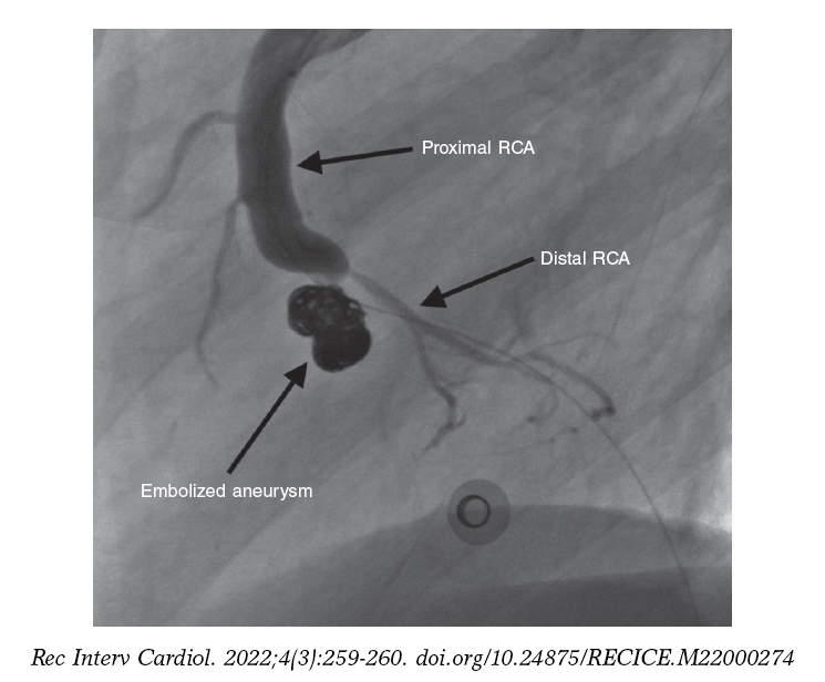Coronary fistula embolization with neurovascular microcoils