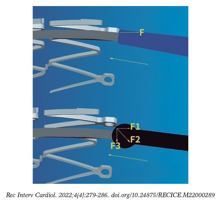 Effectiveness of spherical tip noncompliant balloon for stent ...