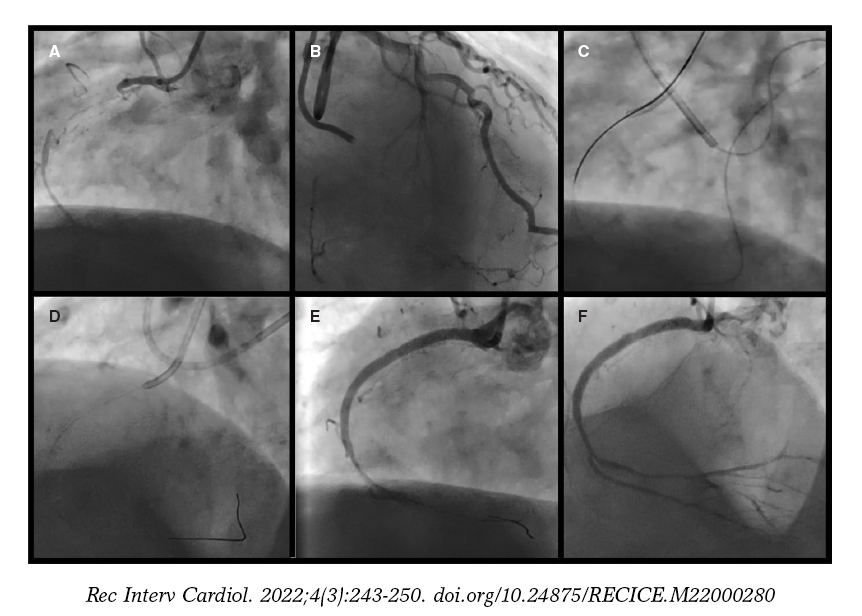 Drug-eluting balloon angioplasty improves the distal run-off in ...