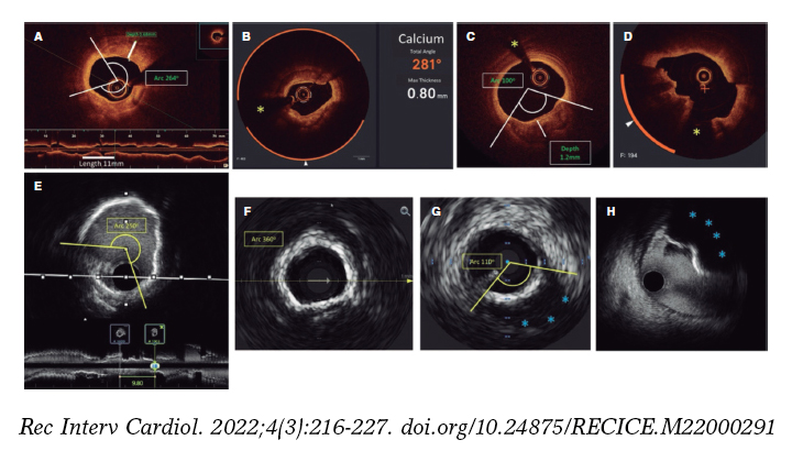 Calcified coronary artery disease: pathophysiology, intracoronary ...