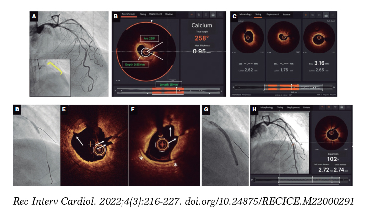 Calcified coronary artery disease: pathophysiology, intracoronary ...