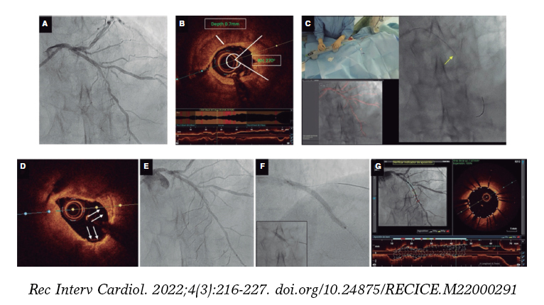 Calcified coronary artery disease: pathophysiology, intracoronary ...