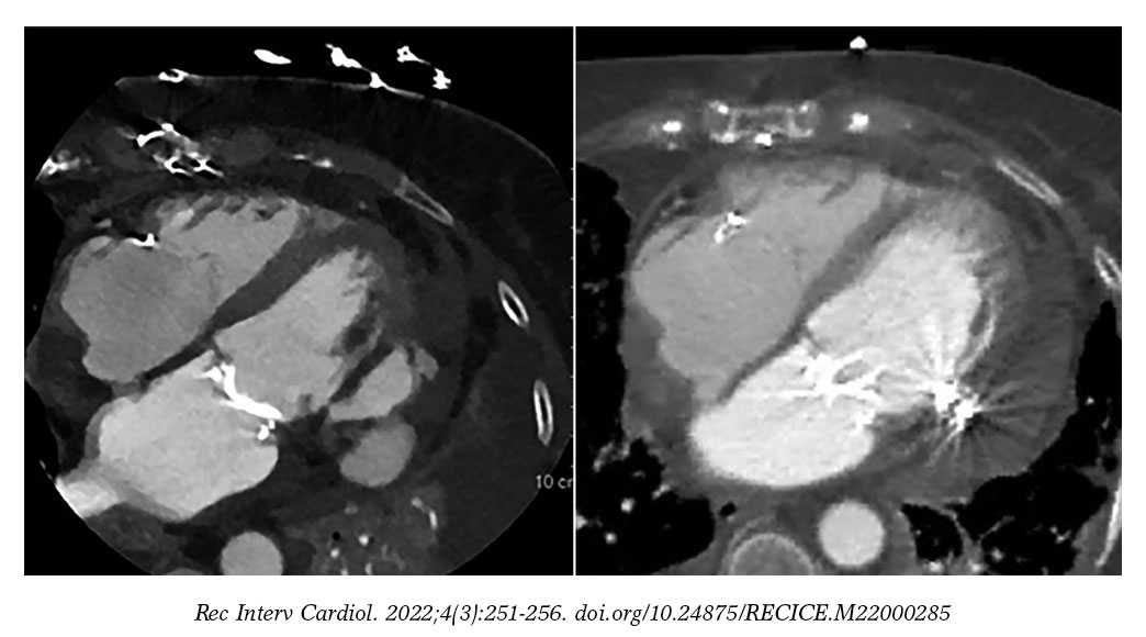 Percutaneous closure of left ventricular pseudoaneurysm. Case resolution