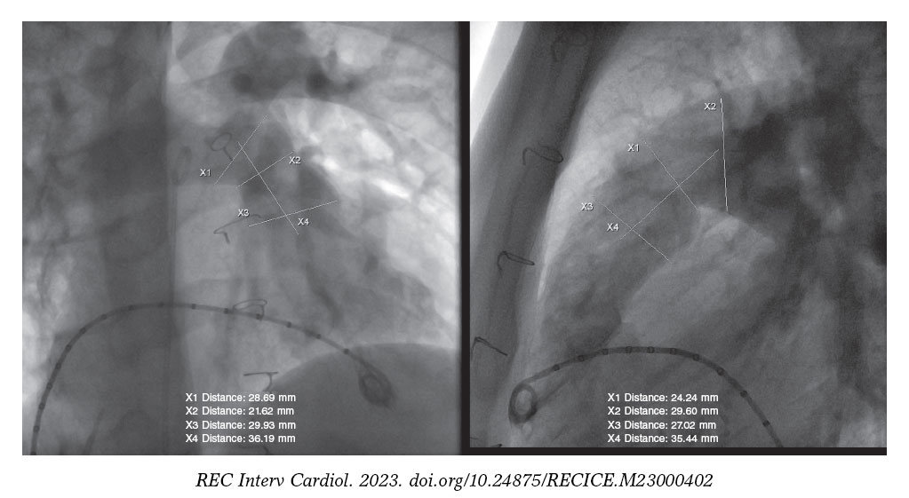 The PULSTA valve in native right ventricular outflow tract: initial ...