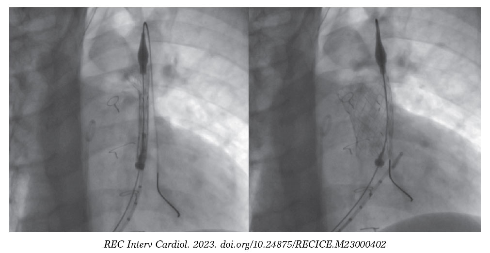The PULSTA valve in native right ventricular outflow tract: initial ...
