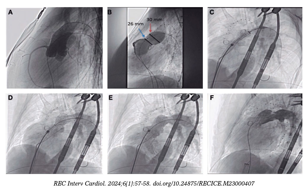 Implantation of a pulmonary bioprosthetic valve in a single pulmonary ...