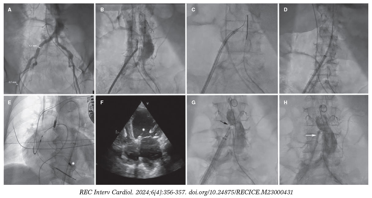 Transcaval access for mechanical circulatory support in cardiogenic shock