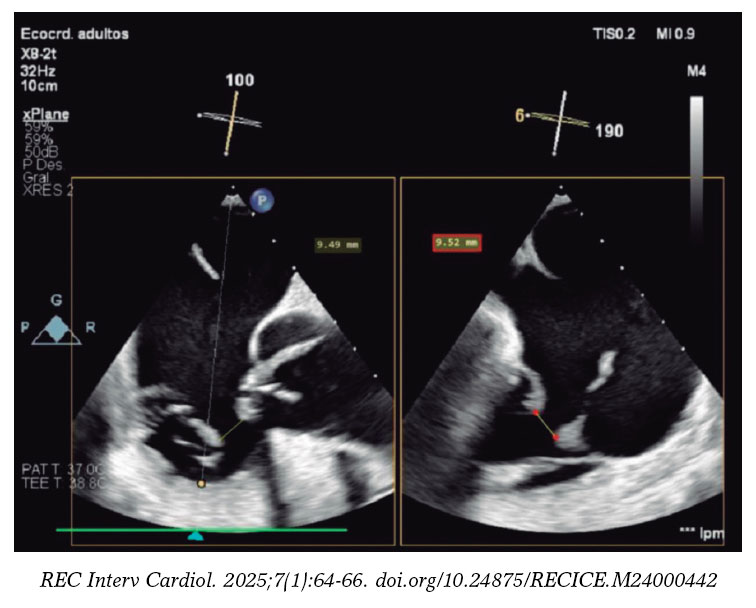 Two simultaneous TriClip systems as a bailout technique