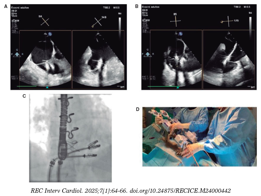 Two simultaneous TriClip systems as a bailout technique
