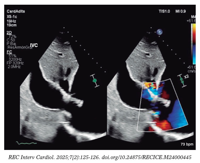 A new echocardiographic view for the TricValve system