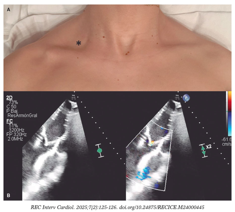 A new echocardiographic view for the TricValve system