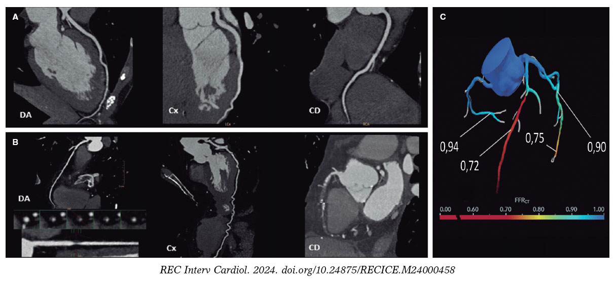 Role of computed tomography in transcatheter coronary and structural ...