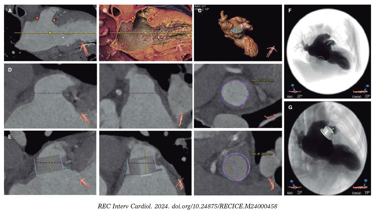 Role of computed tomography in transcatheter coronary and structural ...