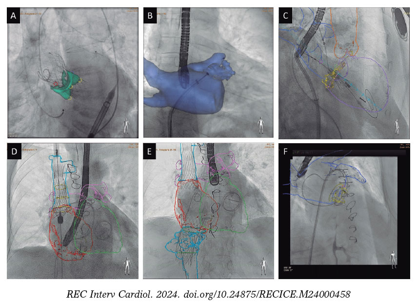 Role of computed tomography in transcatheter coronary and structural ...