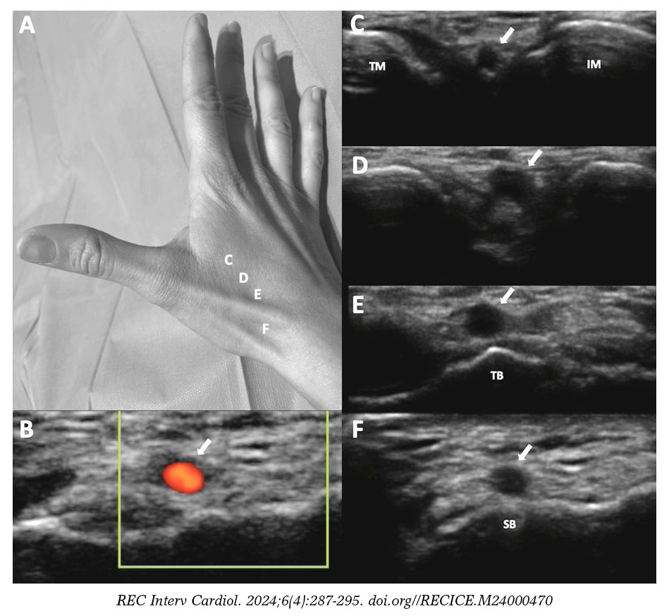 Distal radial access for coronary procedures in an all-comer population ...